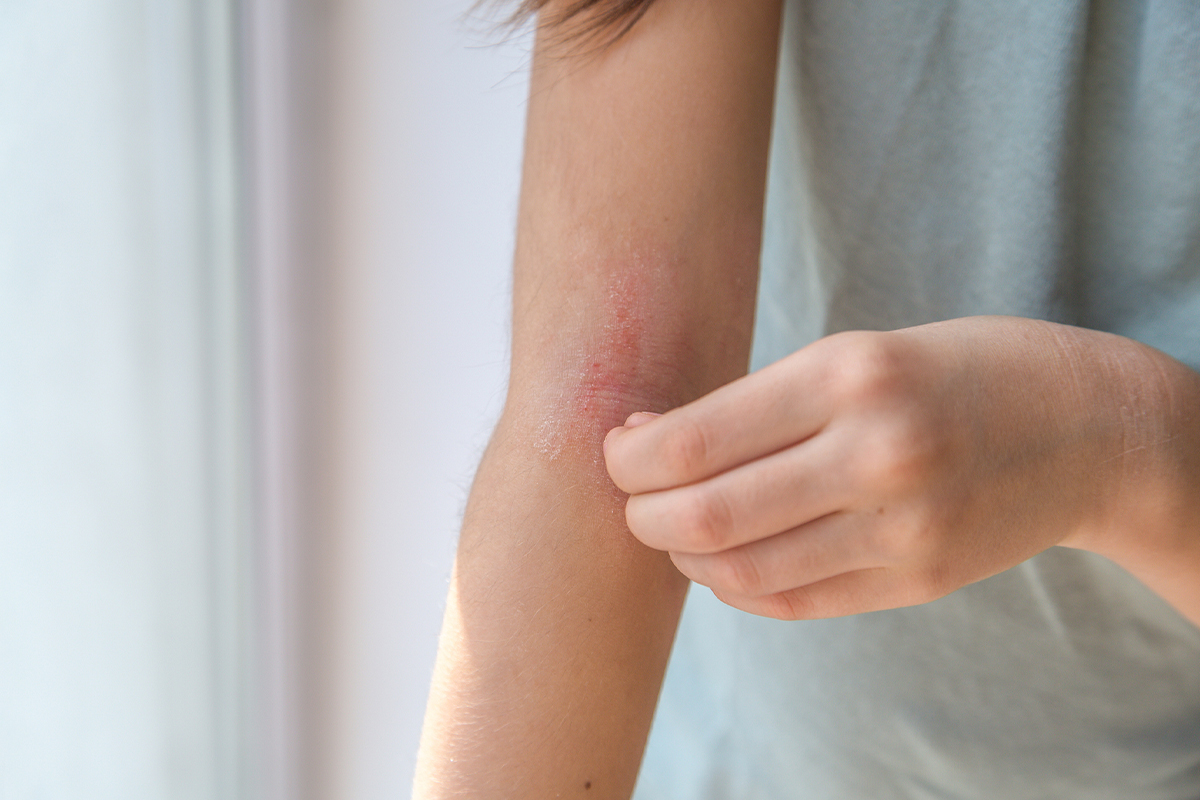 Eczema in Englewood, FL | Seaside Dermatology