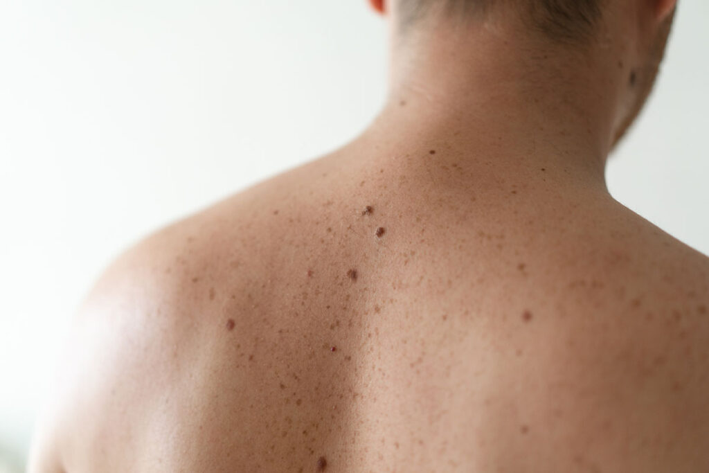 Moles in Englewood, FL | Seaside Dermatology