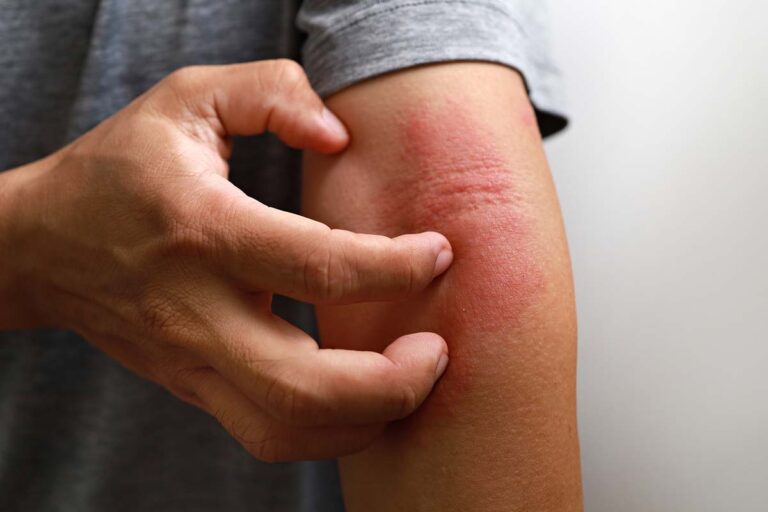 Rashes | Seaside Dermatology