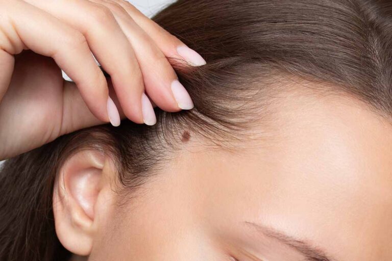 Skin Tags & Moles | Seaside Dermatology