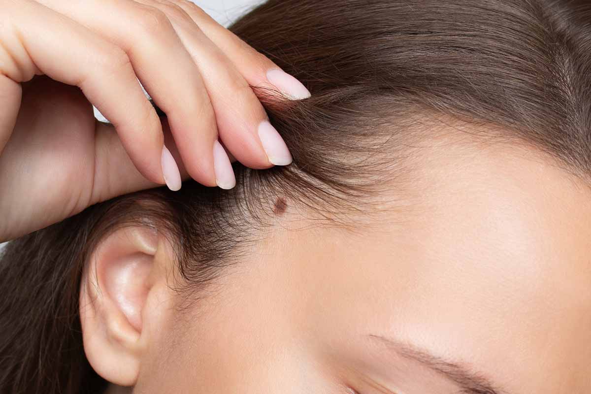 Skin Tags & Moles | Seaside Dermatology