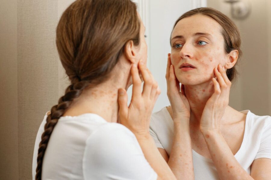 Psoriasis in Englewood, FL | Seaside Dermatology